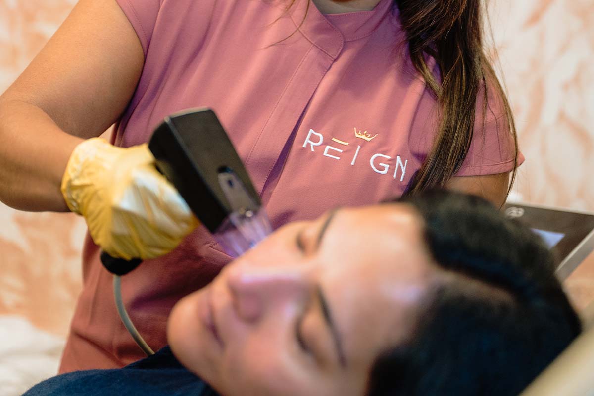 Morpheus8 RF Microneedling in Clermont, FL | Reign Medical Aesthetics Morpheus8 RF Microneedling in Clermont, FL | Reign Medical Aesthetics